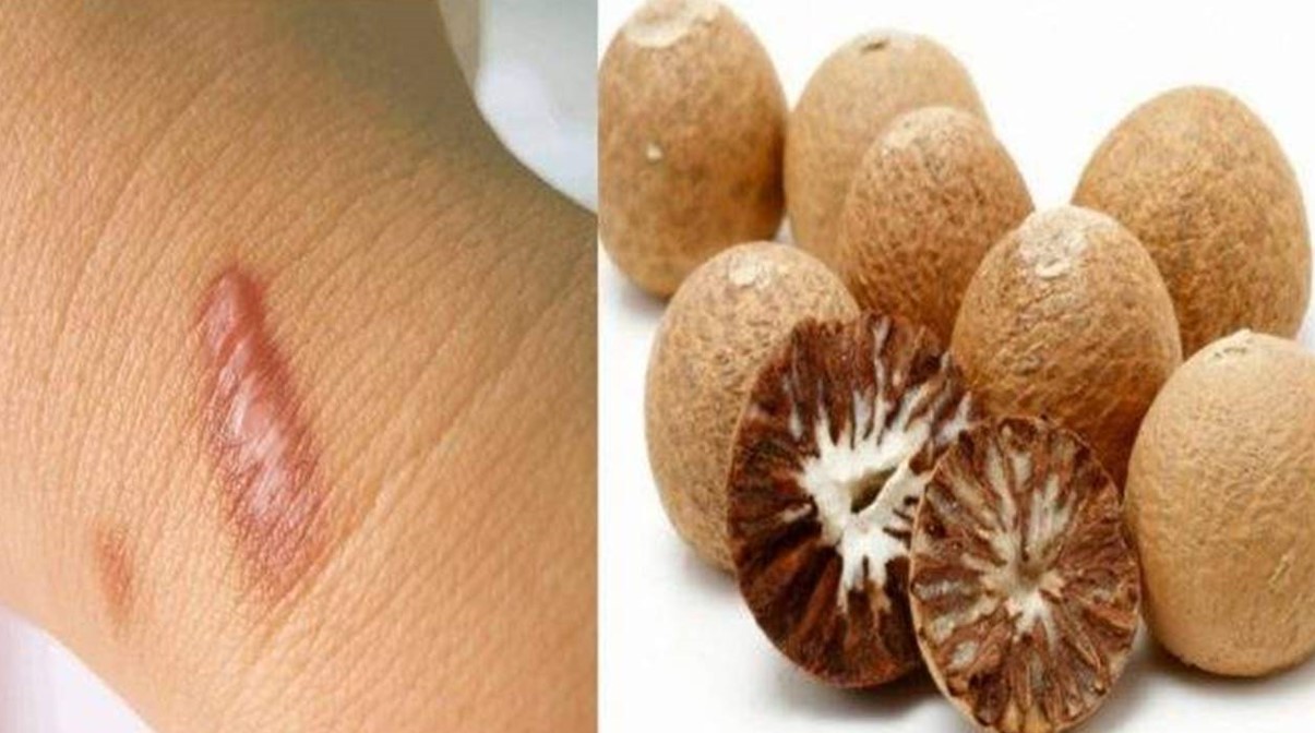 How to get rid of burn scars